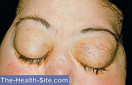 Le Syndrome De Cushing: Causes, Signes, Diagnostic 💊 Scientifique Et ...