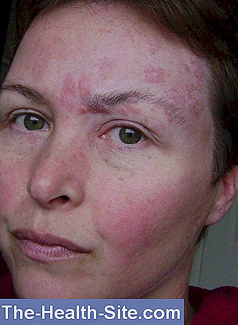 Shingles On The Face Causes History Prognosis 💊 Scientific Practical Medical Journal 2025