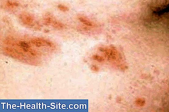 Shingles Herpes Zoster Infection Symptoms Treatment 💊 Scientific