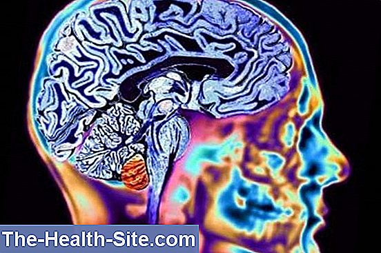 La Enfermedad De Huntington: Causas, Síntomas, Terapia 💊 Científico ...