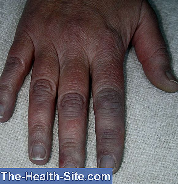 Cianosis: Causas Y Posibles Enfermedades 💊 Científico-Práctico Medical ...