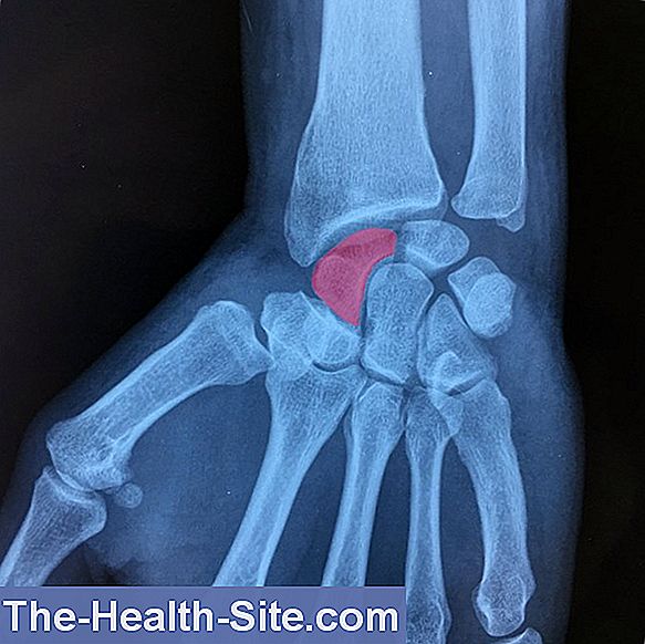 Fracture De Ponction: Causes, Symptômes, Traitement 💊 Scientifique Et ...