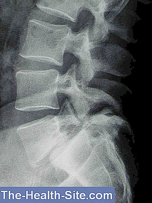 Spondilolistesi: Cause, Trattamento, Prognosi 💊 Scientifico-Pratico ...