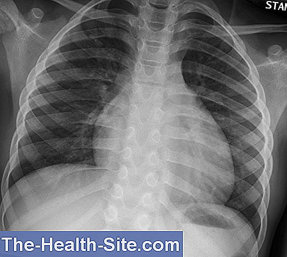 Røntgen (Thorax): Grunner, Utløp, Uttrykksevne 💊 Scientific-Praktisk ...