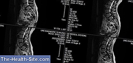 Spondilolisteză: Cauze, Tratament, Prognostic 💊 Științifico-Practic ...