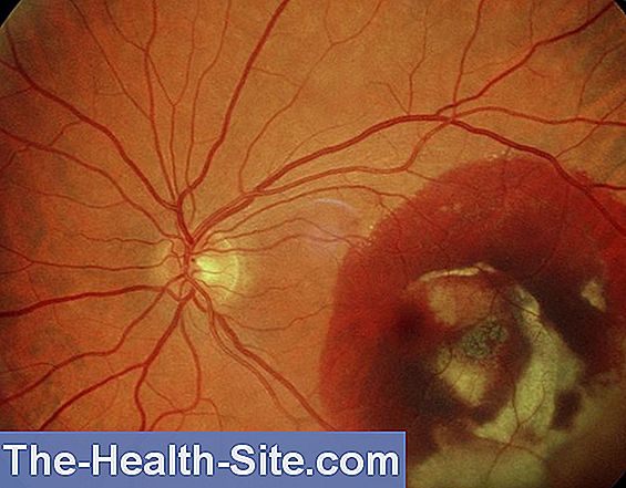 Macular Degeneration: Orsaker, Konsekvenser, Terapi 💊 Scientific ...