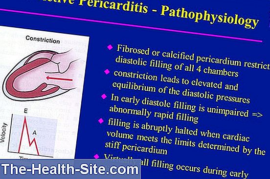 Pericarditis - Pericarditis 💊 Científico-Práctico Medical Journal - 2025