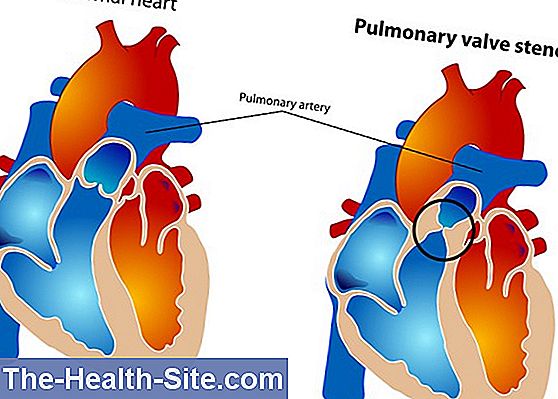 Estenose Pulmonar - Estenose Da Valva Pulmonar 💊 Científico-Prática ...